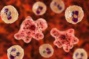 Understanding CSF Leaks: Causes, Symptoms, and Risks - Dr. Amy Anstead